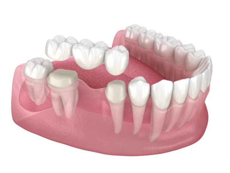 Difference Between Partial Dentures and Dental Bridges | J.B. Dental